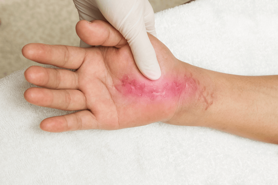 Scar Injury Claims – How Much Compensation Can You Claim? - Claim Justice
